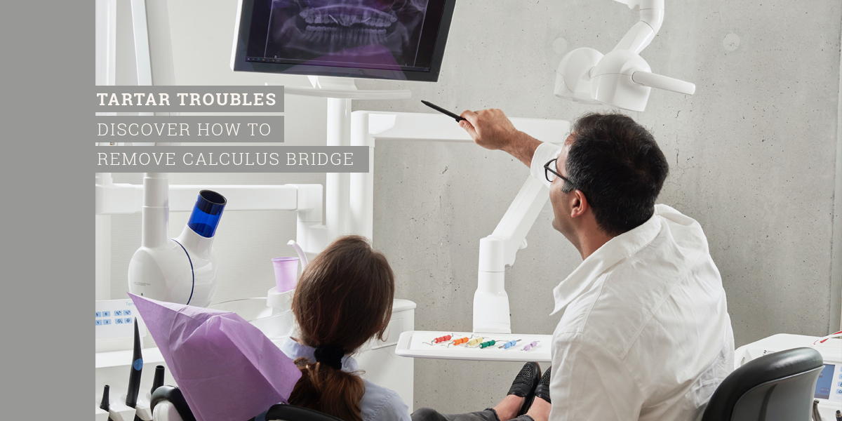 Tartar Troubles? Discover How to Remove Calculus Bridge - Healthy Smart ...